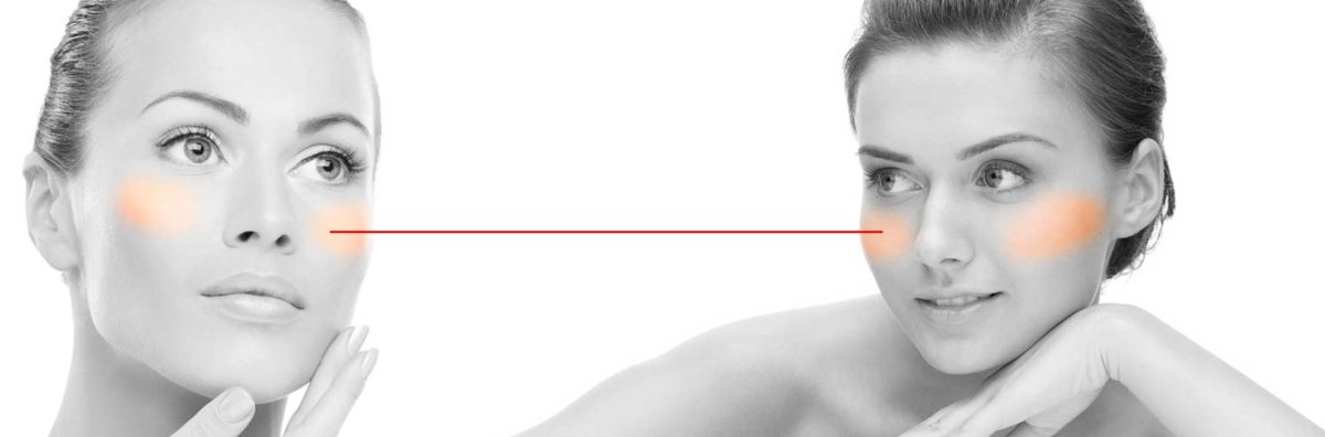 Augmentation des pommettes par injection d'acide hyaluronique Paris